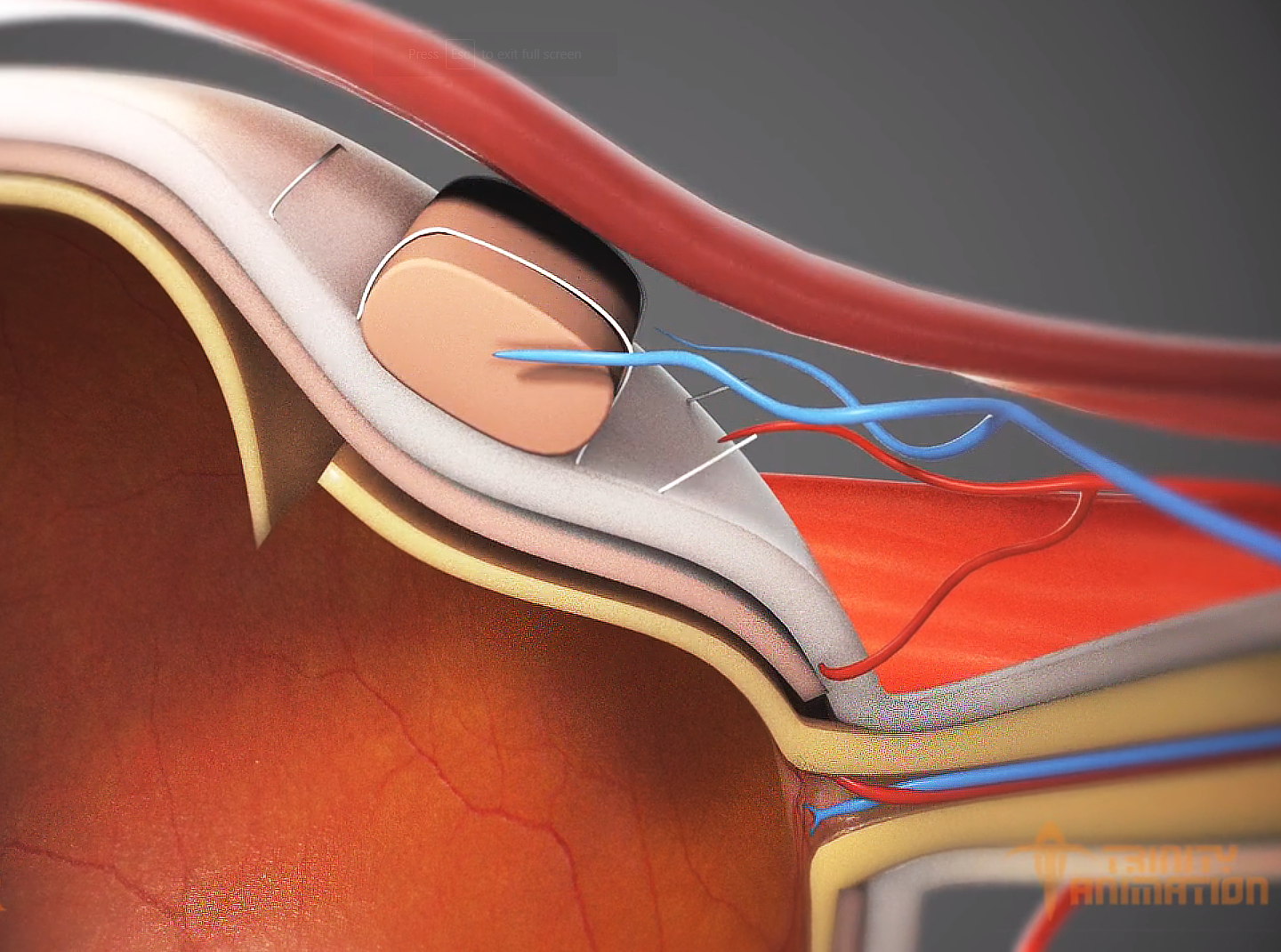 Surgical Animations - Eye and Optical - Medical, Technical, Marketing ...